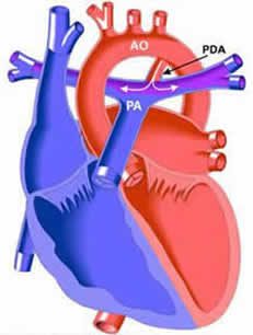 Cross-section of the heart depicting the patent ductus arteriosus
